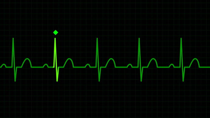 Electrocardiogram (ECG/EKG) Traces - Unity Engine - Unity Discussions